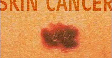 Detecting Skin Cancer - CBS News