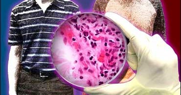 Syphilis On The Rise In U.S. Again - CBS News