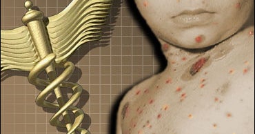 Docs Pan 'Pox Parties' - CBS News
