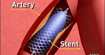 New Brain Stent Opens Blocked Arteries - CBS News