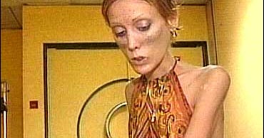 Anorexic Model On Road To Recovery - CBS News