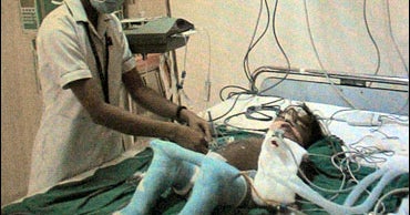 Surgery On Multi-Limbed Girl A Success - CBS News