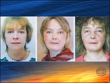 Amazing face transplants (GRAPHIC IMAGES)