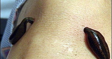 Leeches: Beauty Treatment Or Pain Reducer? - CBS News