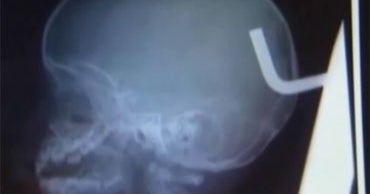 "Miracle Baby" Survives Rod Through the Head - CBS News