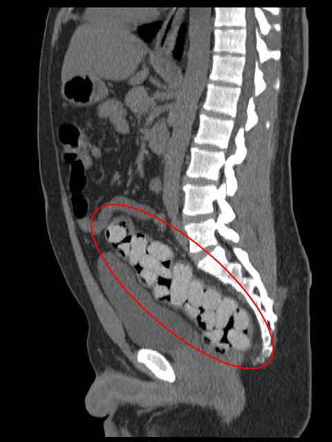 Busted! Drug mules caught on CT scans