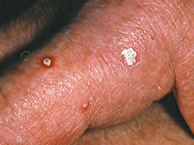 Is it skin cancer?