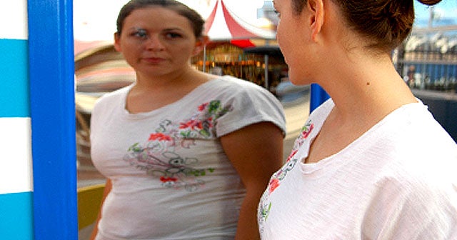 Anorexia sufferers five times more likely to die sooner - CBS News