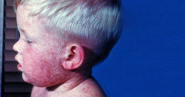 Ohio measles outbreak spreads to record level - CBS News