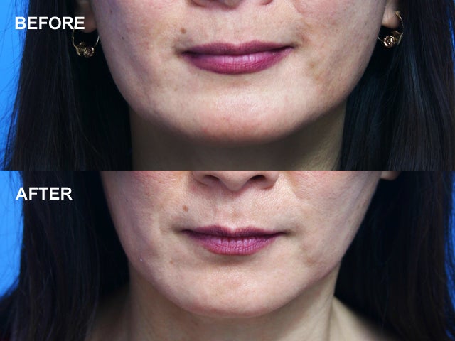 13 bizarre but popular plastic surgery procedures