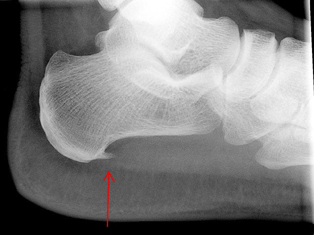 Ouch! 7 nasty foot flaws and how to fix them (GRAPHIC IMAGES)