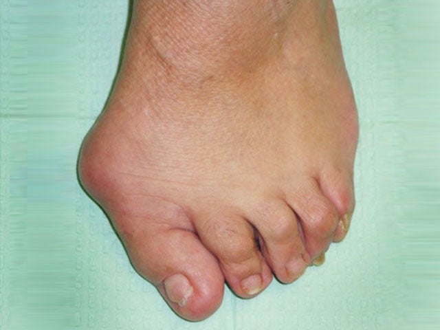 Ouch! 7 nasty foot flaws and how to fix them (GRAPHIC IMAGES)