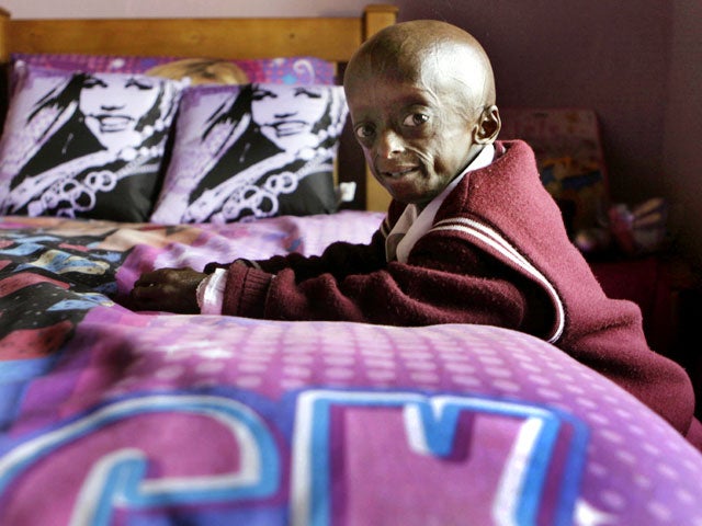 Progeria: First black child with rare aging disease