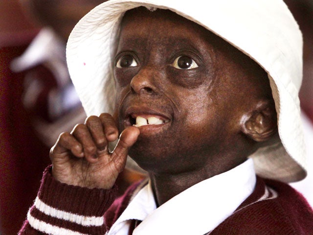 Progeria: First black child with rare aging disease