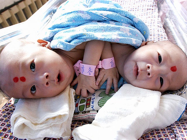Conjoined twins (WARNING: GRAPHIC IMAGES)