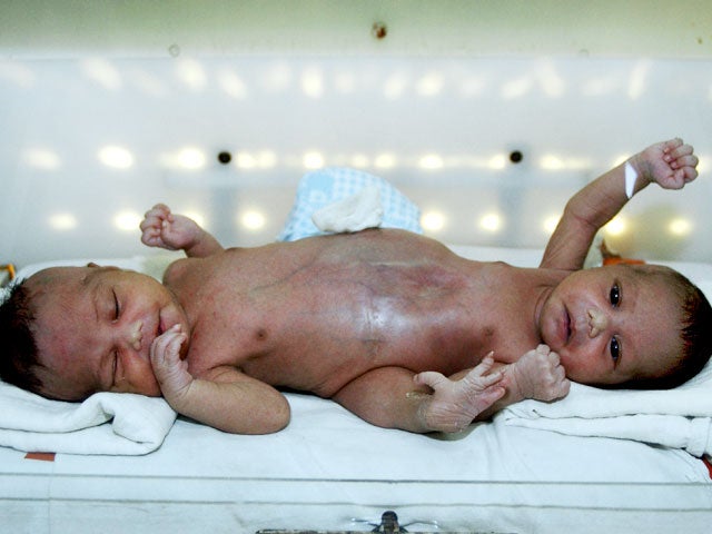 Conjoined twins (WARNING: GRAPHIC IMAGES)