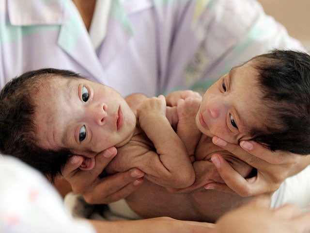 Conjoined twins (WARNING: GRAPHIC IMAGES)