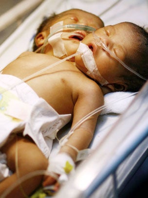 Conjoined twins (WARNING: GRAPHIC IMAGES)