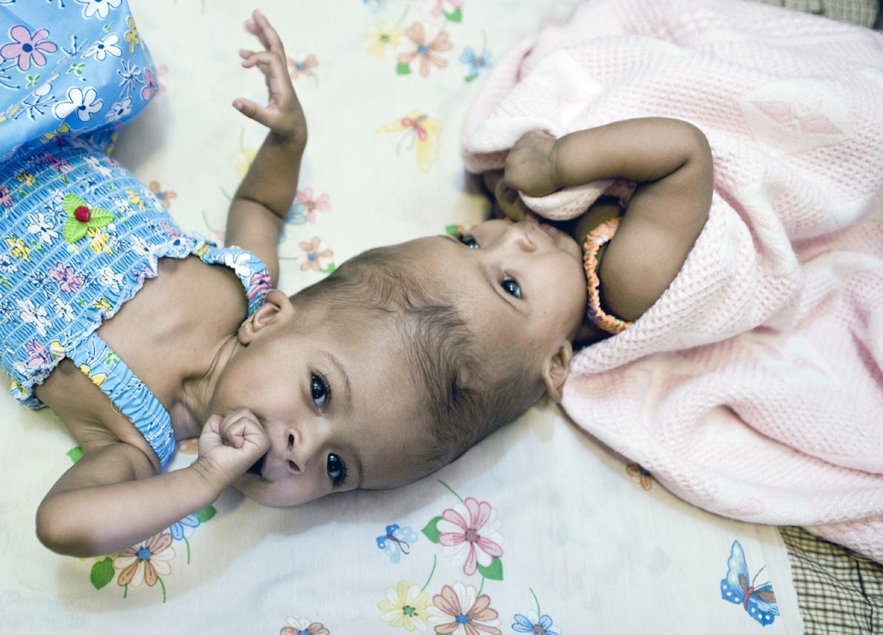 Conjoined twins (WARNING: GRAPHIC IMAGES)