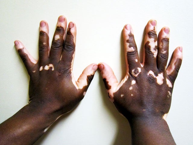 Vitiligo: Illustrated guide to pigmentation disorder