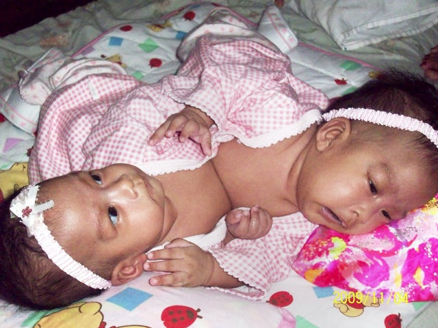 Conjoined twins (WARNING: GRAPHIC IMAGES)