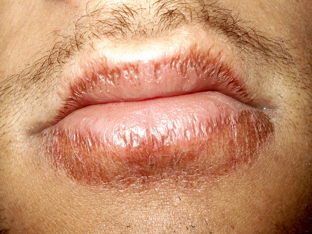 From bloating to hiccups: How to get rid of annoying health problems