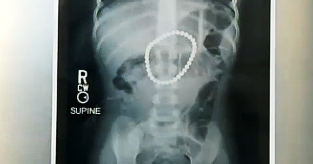 Kids' emergency room visits due to magnet injuries on the rise - CBS News