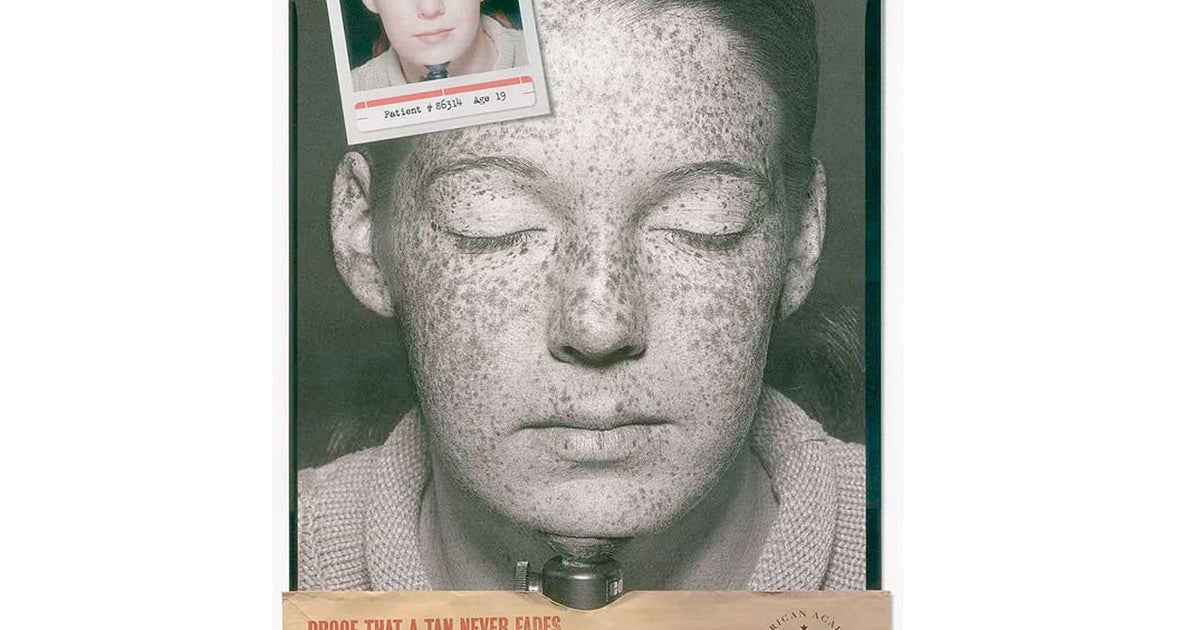 UV photographs may reveal potential for getting skin cancer - CBS News