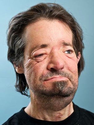 Amazing face transplants (GRAPHIC IMAGES)