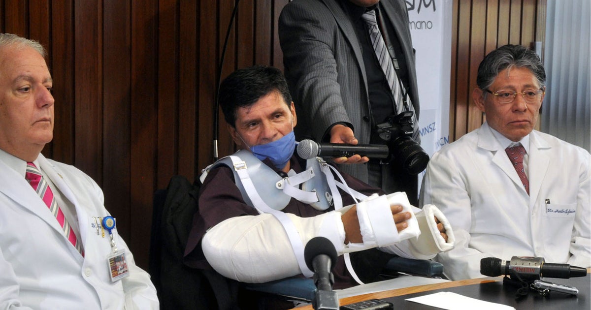 Man gets double arm transplant in Mexico - CBS News