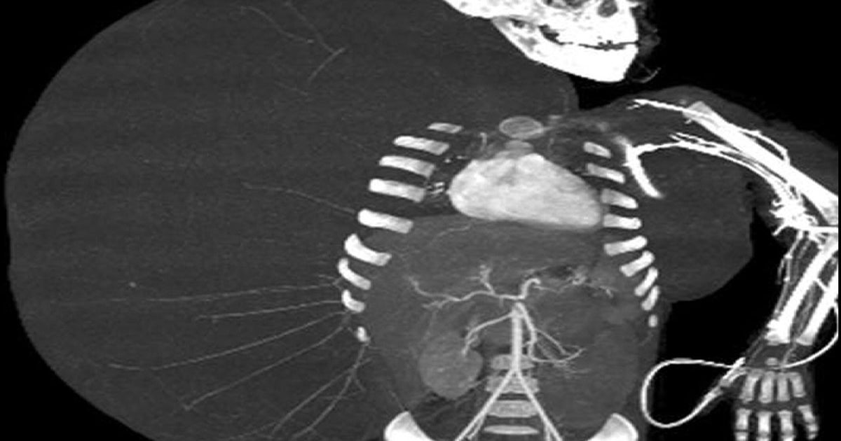 Mexican doctors remove 33-pound tumor from 26-pound 2-year-old - CBS News