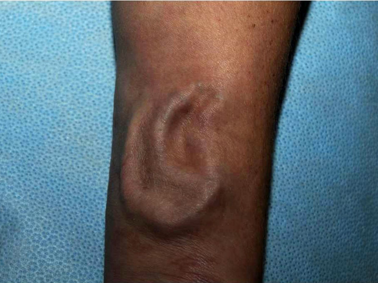 Ear reconstruction surgery (Graphic Photos)