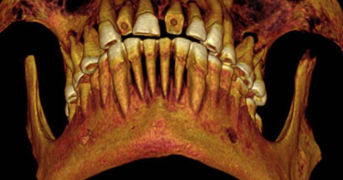 Mummy discovered with mouthful of cavities - CBS News