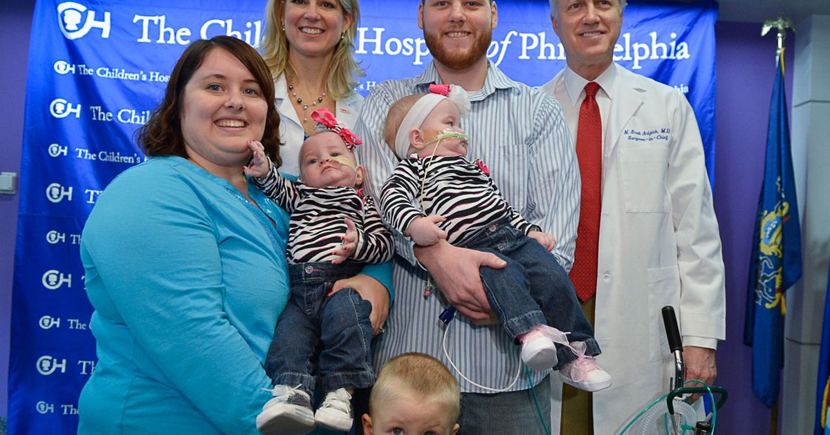 Previously conjoined twins Allison and Amelia make their public debut ...