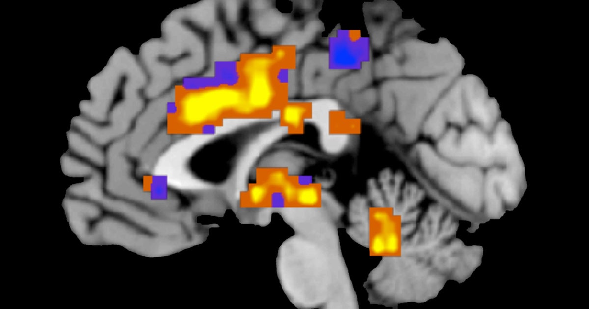 Doctors use brain scans to "see" pain - CBS News