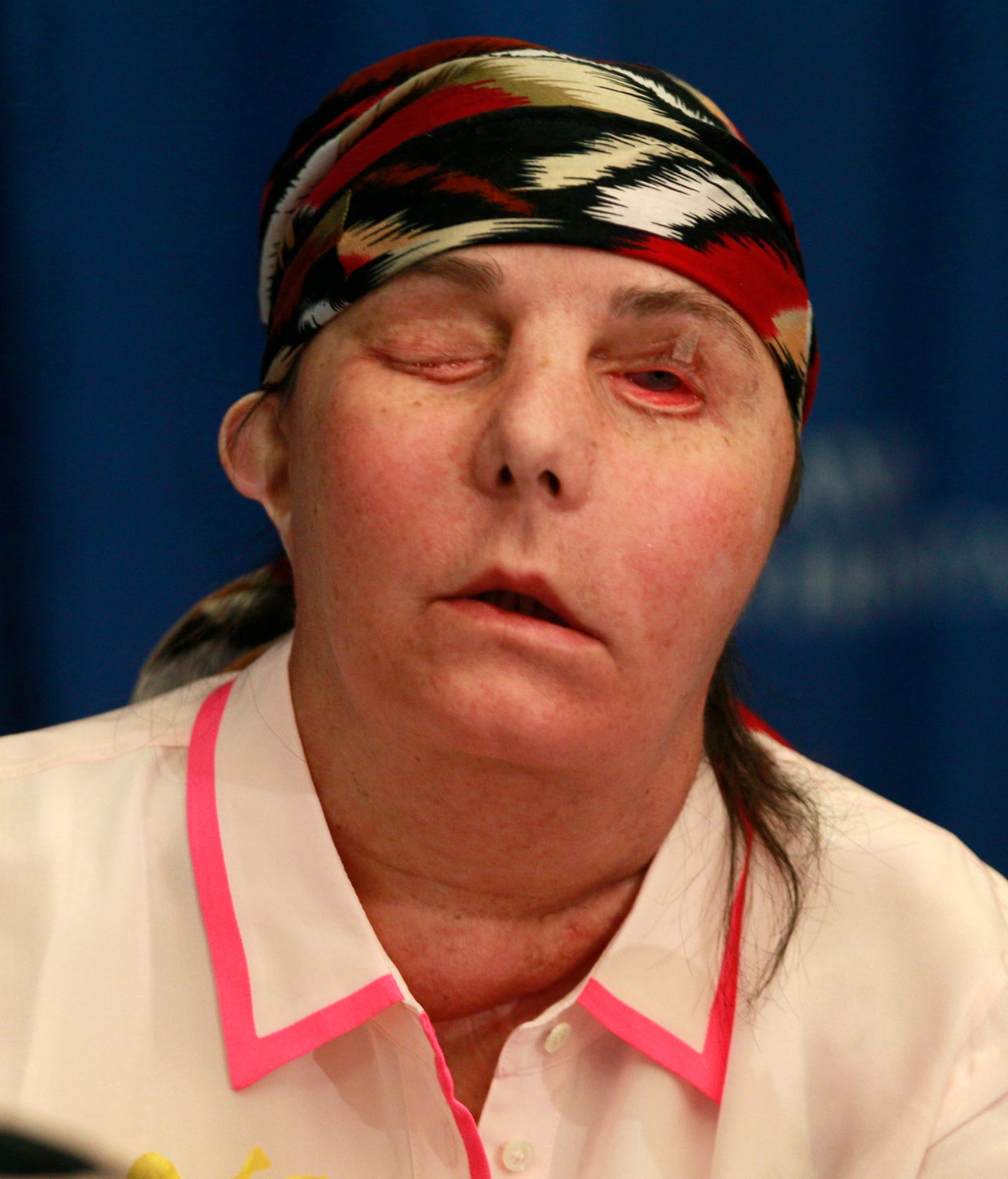 Amazing face transplants (GRAPHIC IMAGES)