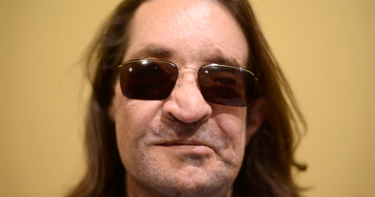 Face transplant recipients see progress years later - CBS News