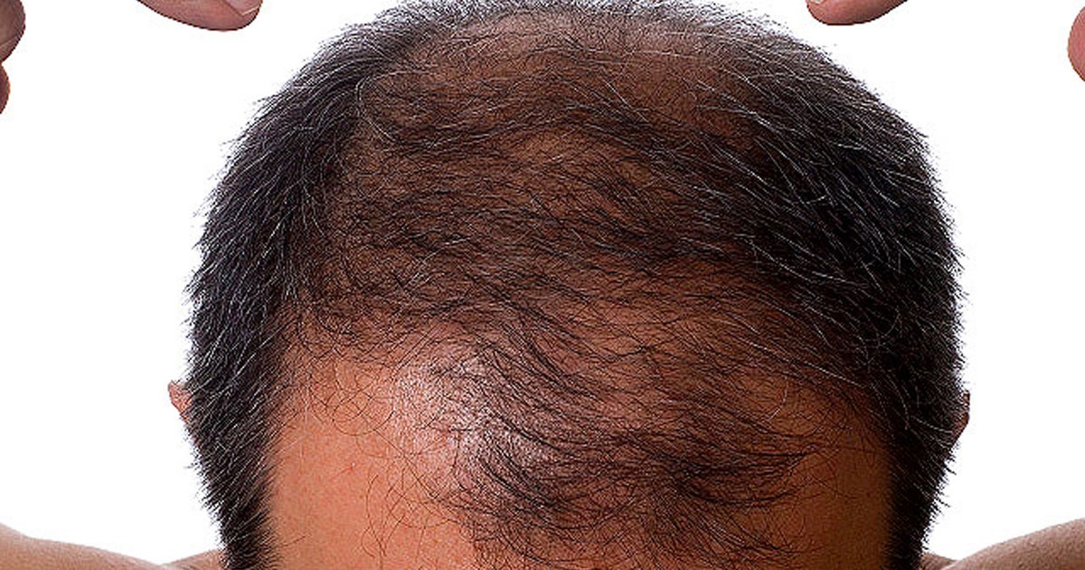 Bye bye baldness? Researchers regrow hair using skin cells - CBS News