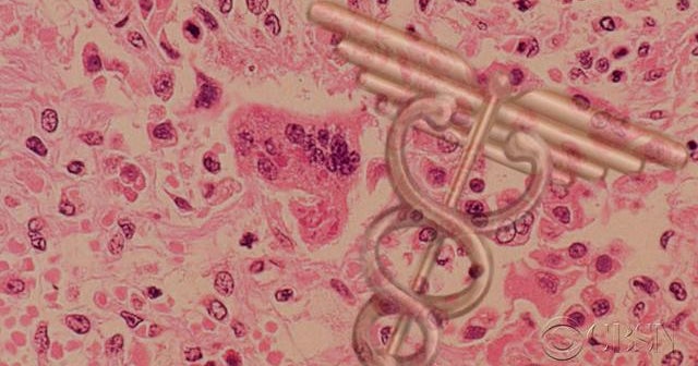 Disney measles outbreak may have originated in the Philippines - CBS News