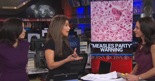 California health officials warn against measles parties - CBS News