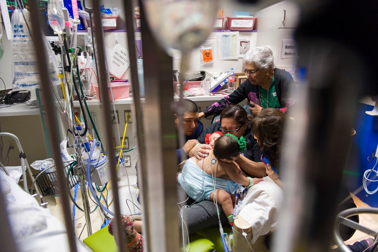 Conjoined twins Knatalye and Adeline Mata separated in Texas