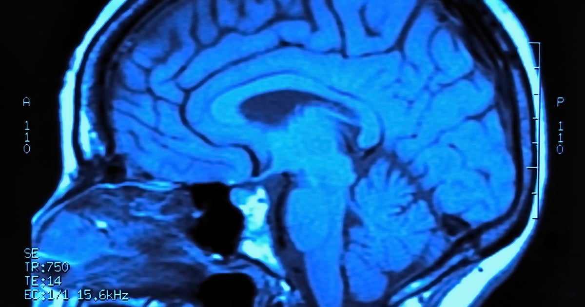 Stuttering mysteries unfold in brain imaging study - CBS News