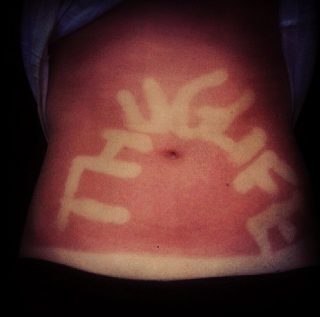 sunburn drawing reference