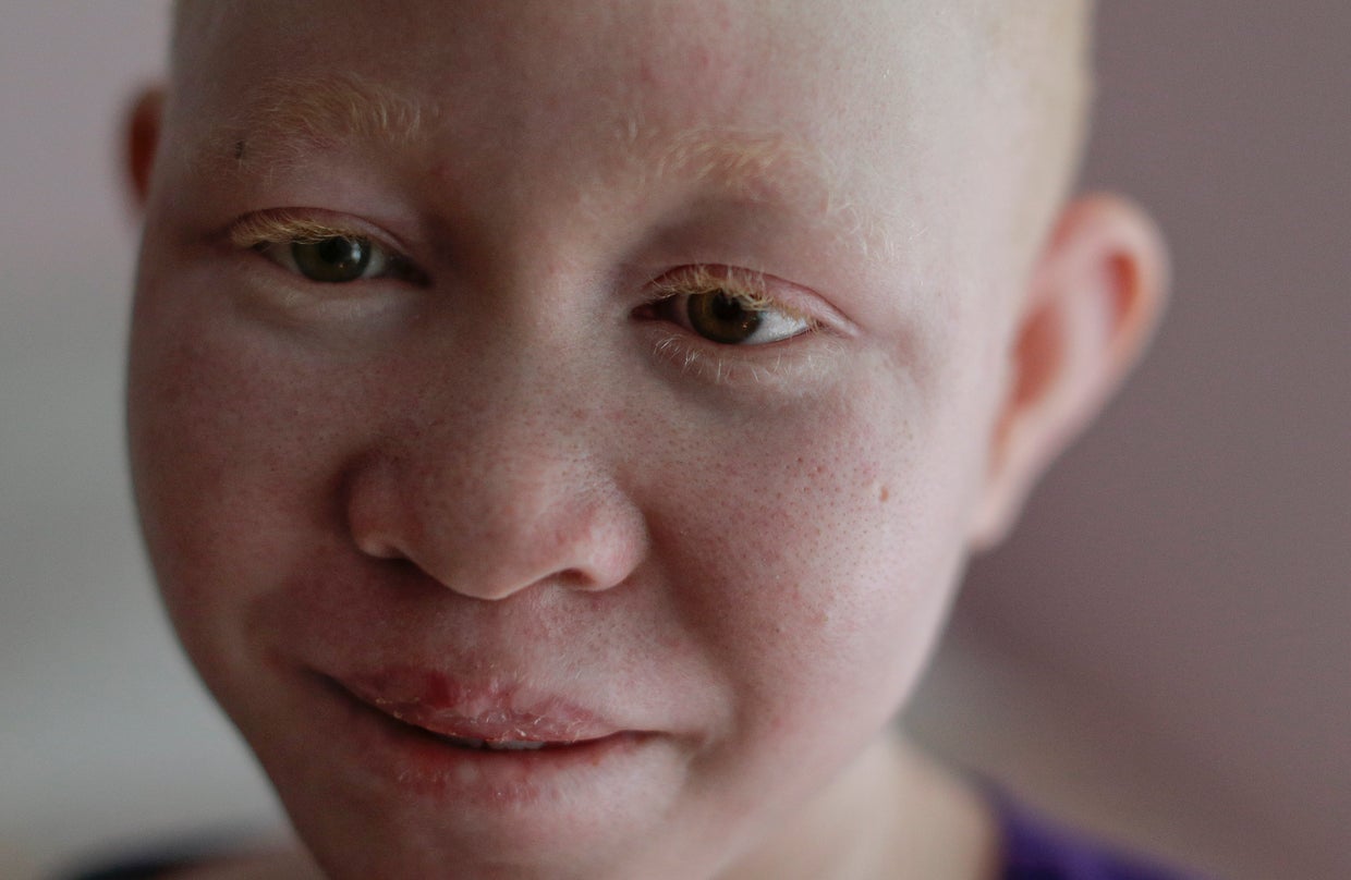 New limbs, new hope for Africa's hunted albino children