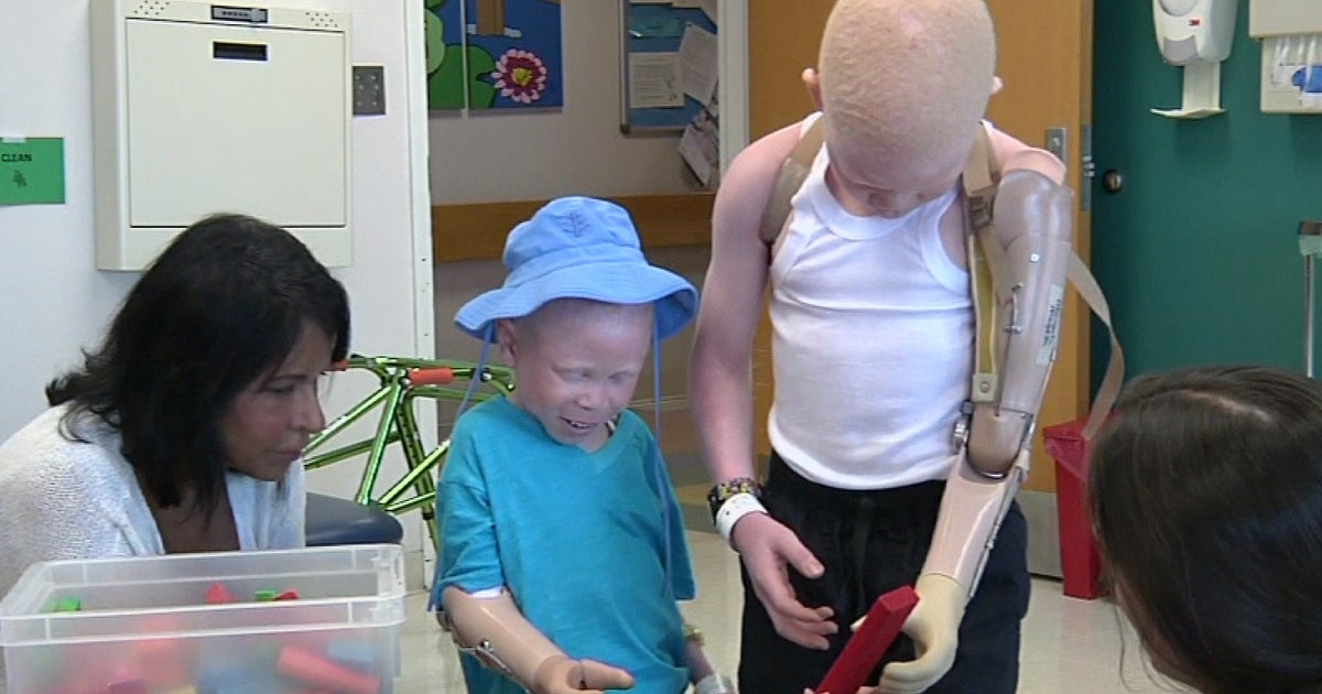 After attacks, Tanzanian children with albinism receive prosthetics ...