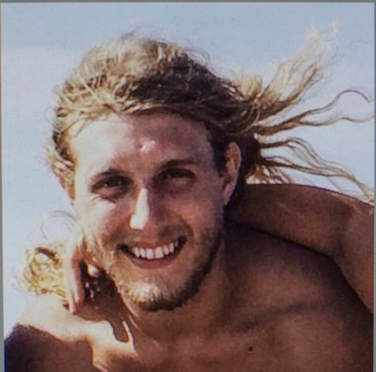 Mississippi firefighter Patrick Hardison gets most extensive face ...