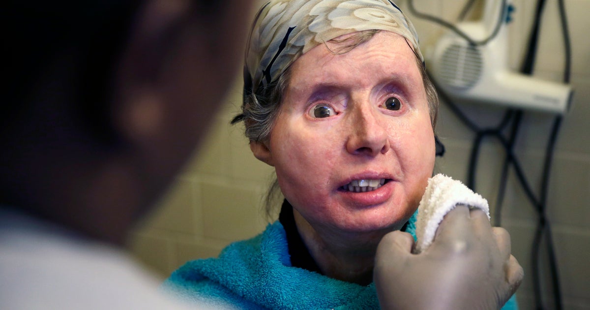 Body of chimp attack victim Charla Nash rejecting face transplant - CBS ...
