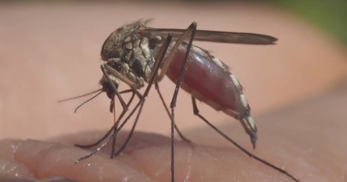 Zika virus can trigger epilepsy - CBS News