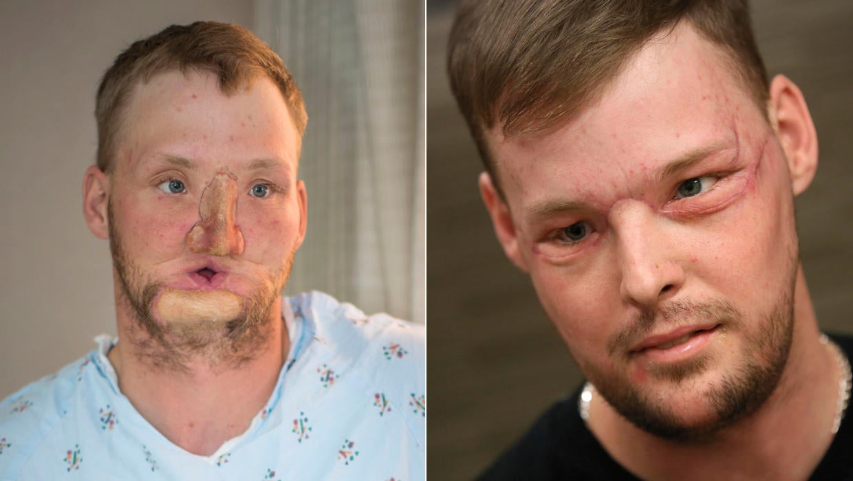 Amazing face transplants (GRAPHIC IMAGES)
