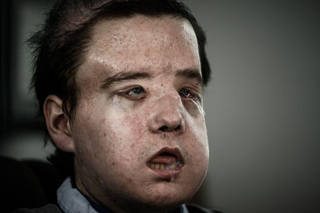 Amazing face transplants (GRAPHIC IMAGES)